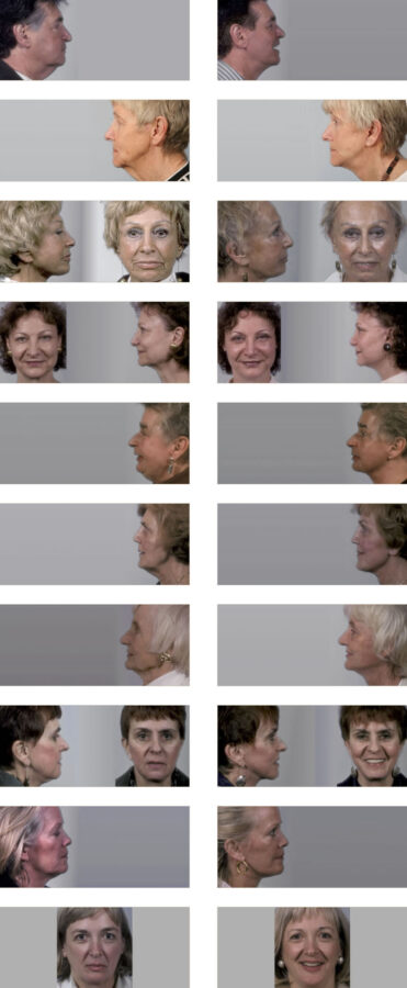 Before & After Photos | Younger Facial Surgery Clinic | Vancouver